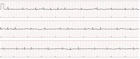 Is This Afib R Readmyecg