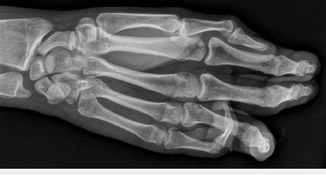 Anterior Posterior Radiograph Of The Hand Shows A Transverse Download Scientific Diagram
