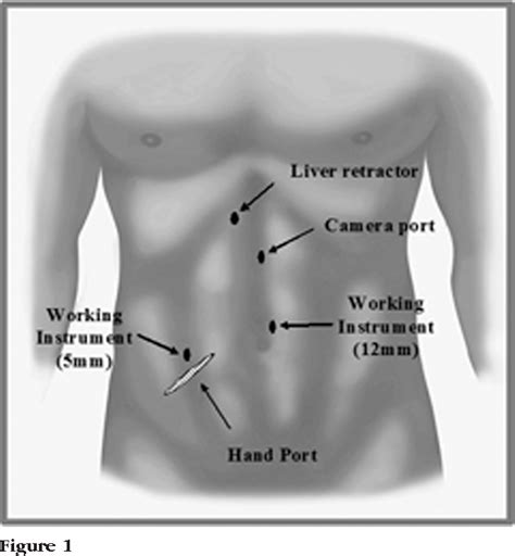Table 1 From Laparoscopic Radical Nephrectomy For Renal Masses 7 Centimeters Or Larger