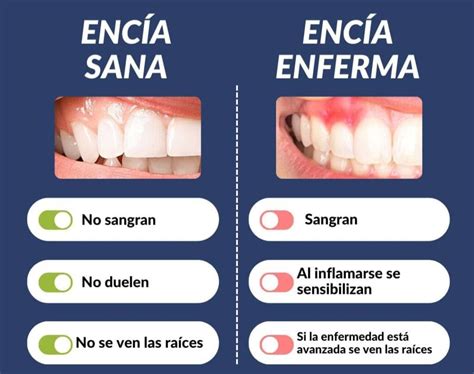 Encía Retraída En Un Diente Por Qué Ocurre Y Cómo Se Puede Tratar
