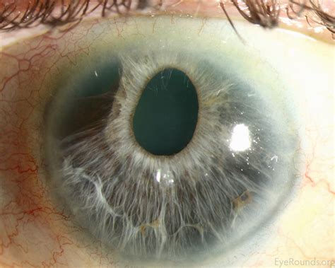 Atlas Entry Essential Iris Atrophy Iridocorneal Endothelial ICE Syndrome