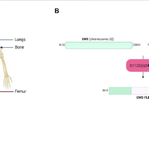 A Primary And Metastatic Sites Of Ewing Sarcoma Ewing Sarcoma Mainly Download Scientific