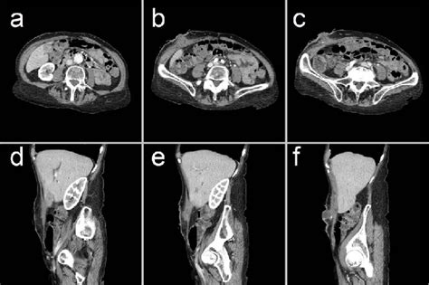 Representative Ct Images Showing A C Axial And D F Sagittal Views Download Scientific