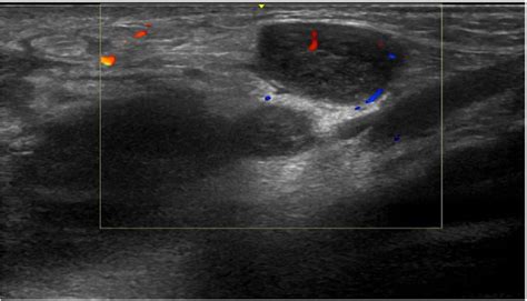Painful Enlarged Inguinal Lymph Nodes After Unprotected Sex Semantic
