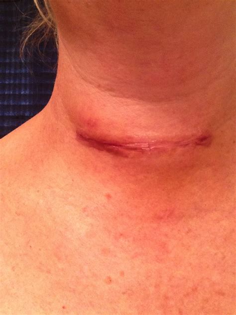 Thyroidectomy Saturday 11913 4th Day After Surgery Valerienev