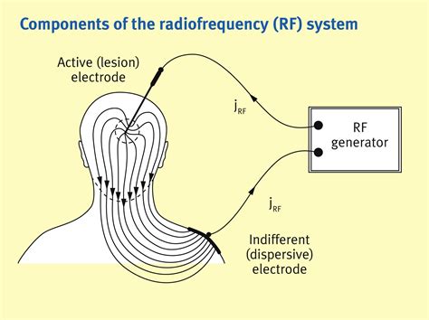 References In Radiofrequency Techniques In Pain Management Anaesthesia And Intensive Care Medicine References In Radiofrequency Techniques In Pain Management Anaesthesia And Intensive Care Medicine