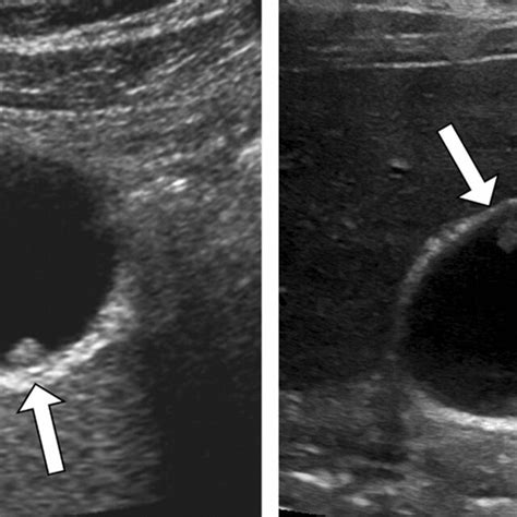 Indeterminate Risk Polyp A Longitudinal Gallbladder Ultrasound