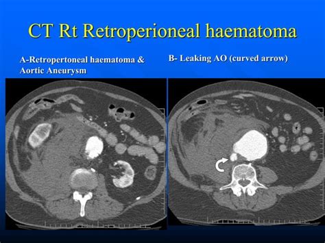 Retroperitoneal Hematoma Types And Management The Lect Ppt