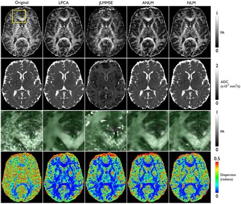 Diffusion Tensor Metrics The Original Low Snr Data Yielded Maps Of