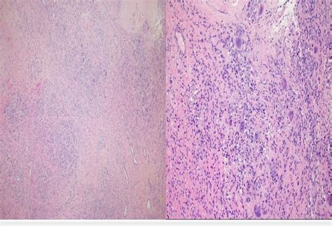 Histopathological Appearance Showed Polymorphous Population Of Cells