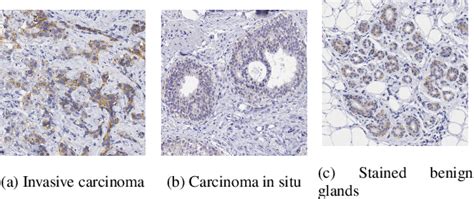 Interpretable Her2 Scoring By Evaluating Clinical Guidelines Through A Weakly Supervised
