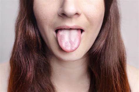 Yeast Infection On Tongue Piercing Getting To The Root Of Ringworm