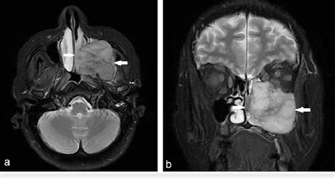Magnetic Resonance Imaging Of The Same Patient T2 Sequence A Axial Download Scientific