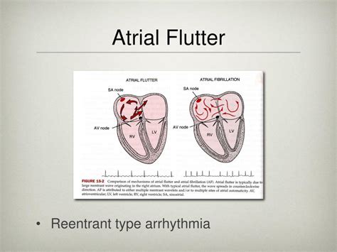 Ppt Atrial Flutter And Atrial Fibrillation Powerpoint Presentation Free Download Id 5190927