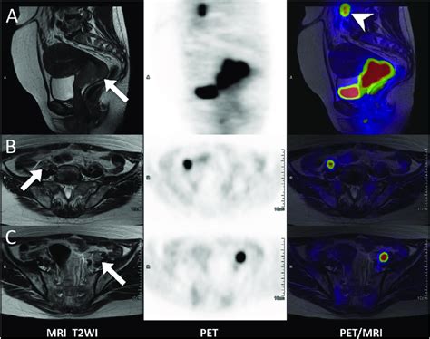 A 51 Year Old Woman With Cervical Cancer Squamous Cell Carcinoma Download Scientific Diagram