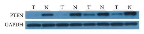Western Blot Analysis Of Pten Expression In Escc Tumor And Normal