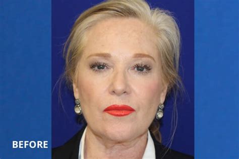 Cheek Filler Before After Pictures Madnani Facial Plastic Surgery