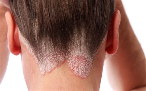 بیماری پسوریازیس چیست؟ علائم بیماری و درمان آن داروخانه آنلاین دکتر داروک