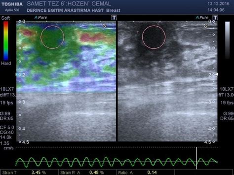 Nodular Gynecomastia Appears As A Solid Retro Areolar Area With A Download Scientific Diagram