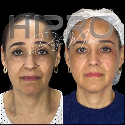 Hiproadvanced Facehof