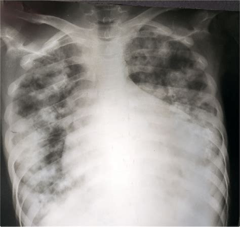 Chest X Ray Shows Multiple Well Defined Opacities With Cavities In Some Download Scientific