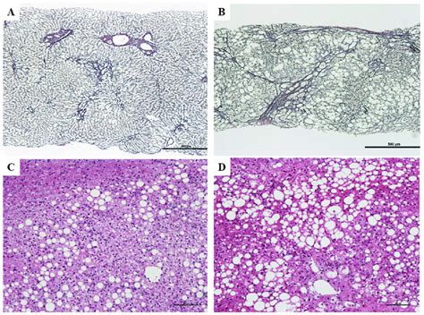 Histological Findings Of Nafld A Tissue Sample With Fibrosis Stage Download Scientific