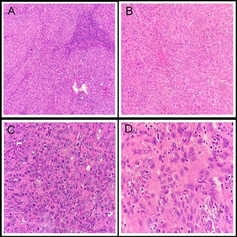Lymph Node Sections Showing The Typical Pathologic Features Of Fdcs Download Scientific