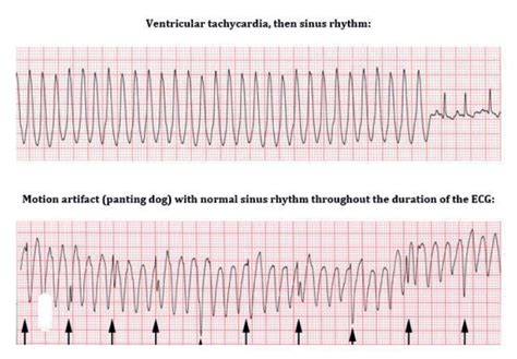 Ventricular Fibrillation Vs Atrial Fibrillation