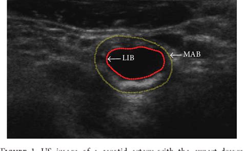 Figure 1 From Ultrasound Common Carotid Artery Segmentation Based On Active Shape Model