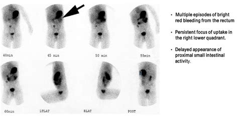 Imaging Meckels Scan