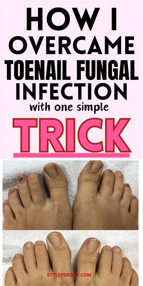 How To Get Rid Of Fungal Toenails 12 Effective Remedies For Toe Nail