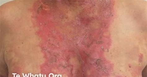 Generalised Pustular Psoriasis Image