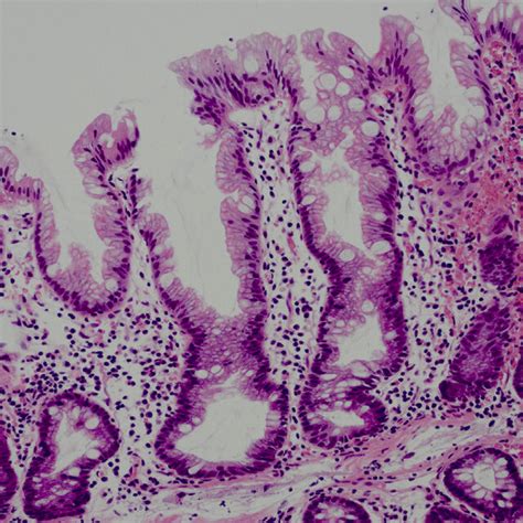 Complete Resection Was Archived With 3 Time Piecemeal Resection