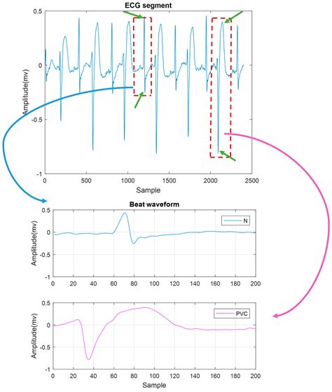 Automated Method For Discrimination Of Arrhythmias Using Time Frequency And Nonlinear Features