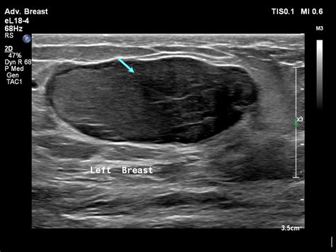 Atlas Of Breast Cancer Early Detection