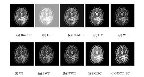 Mri Image Enhancement Based On Feature Clustering In The Nsct Domain