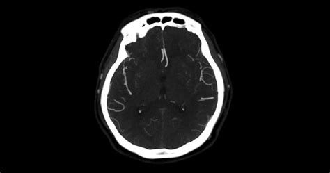 뇌 3d 렌더링 이미지 Ap 및 뇌 동맥을 보여주는 측면 보기의 Cta Brain 또는 Ct 혈관 조영술 Cat 스캔에 대한 스톡 사진 및 기타 이미지 Istock
