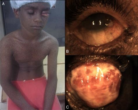 Xeroderma Pigmentosum With Bilateral Ocular Surface Squamous Neoplasia