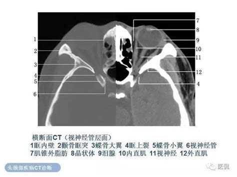眼眶ct解剖图谱 眼眶ct解剖图 伤感说说吧