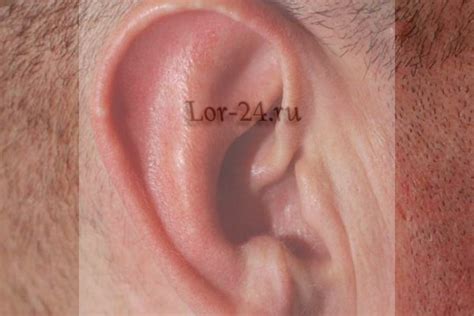 Болит ушная раковина снаружи причины и лечение