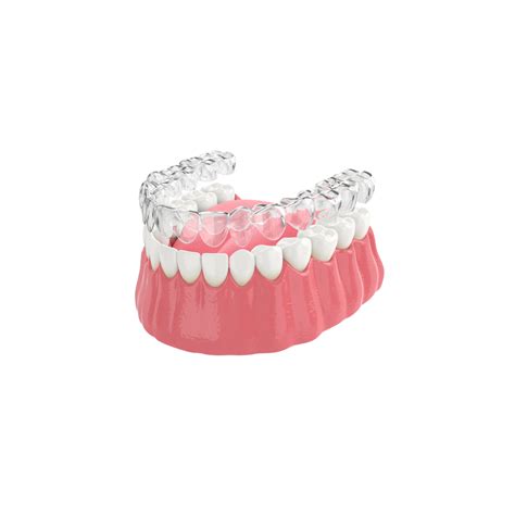 Invisalign Perth Cost Affordable Clear Aligners And Braces
