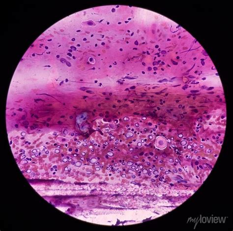 Squamous Intraepithelial Lesion Sil Paps Smear Reactive Cellular • Wall Stickers Vaginal