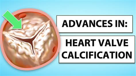 Calcification Of Heart Valves Diagram What Is A Calcified He