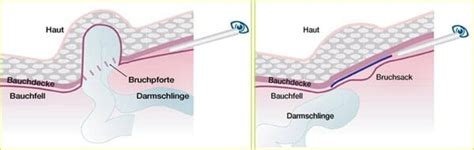 Tep Behandlung Leistenbruch Zentrum Leistenbruch Op In Tepp Tep