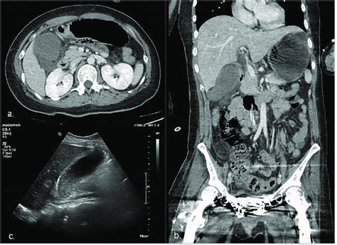 Case 1 Ab Abdomen Pelvic Ct The Gallbladder Gb Is Significantly