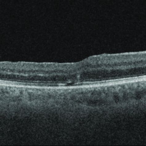 Oct Scan Showing Restored Retinal Layers 2 Years After Surgery Download Scientific Diagram
