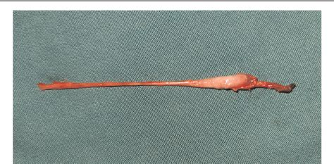 Figure 1 From Testicular Regression Syndrome A Retrospective Analysis Of Clinical And