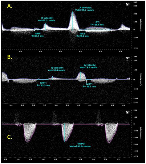 Pulse Wave Doppler Image Of Ventricular Inflow And Outflow