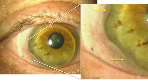 Scleral Lens Complications You Cant Miss Collaborativeeye My Xxx Hot Girl