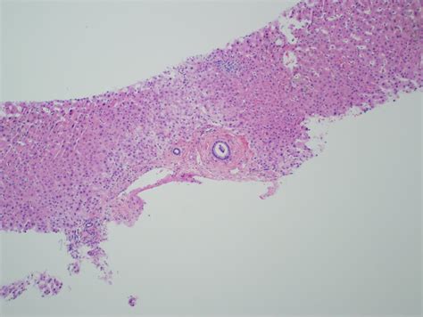 Cholestatic Hepatitis An Unusual Presentation Of Lisinopril Induced Hepatotoxicity British